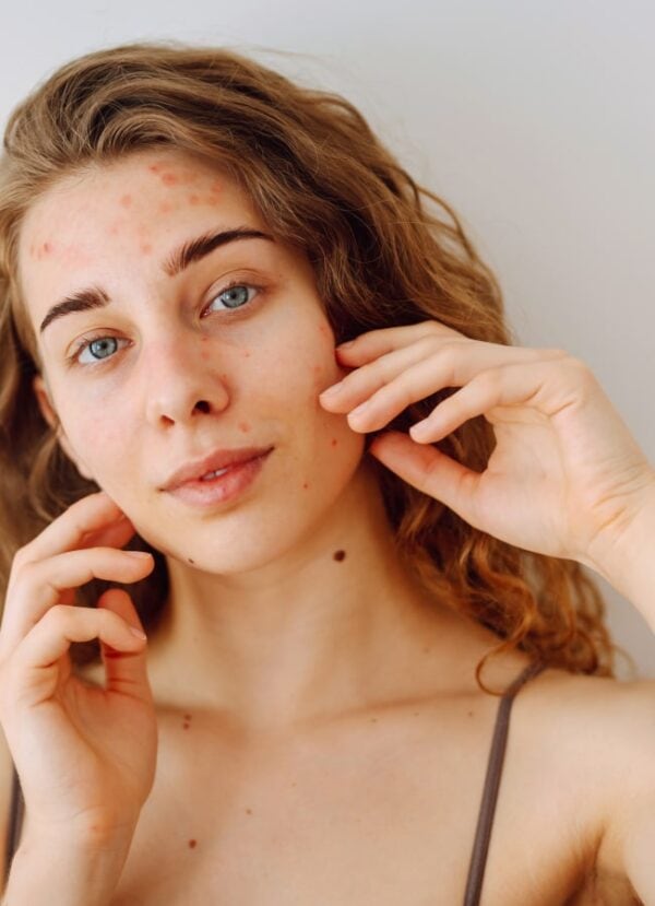 Acne Causes & Treatments - Valley Dermatology
