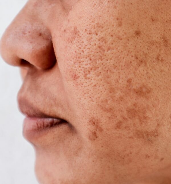 Melasma & Rosacea - Valley Dermatology