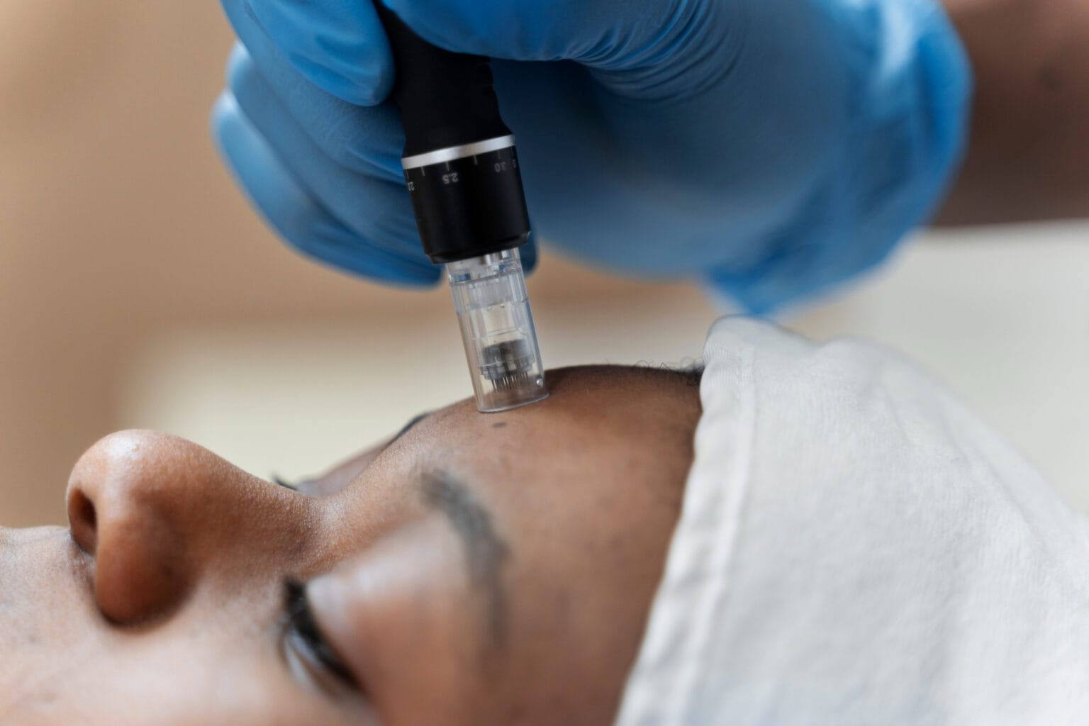 The Guide To Microneedling With PRP - Valley Dermatology